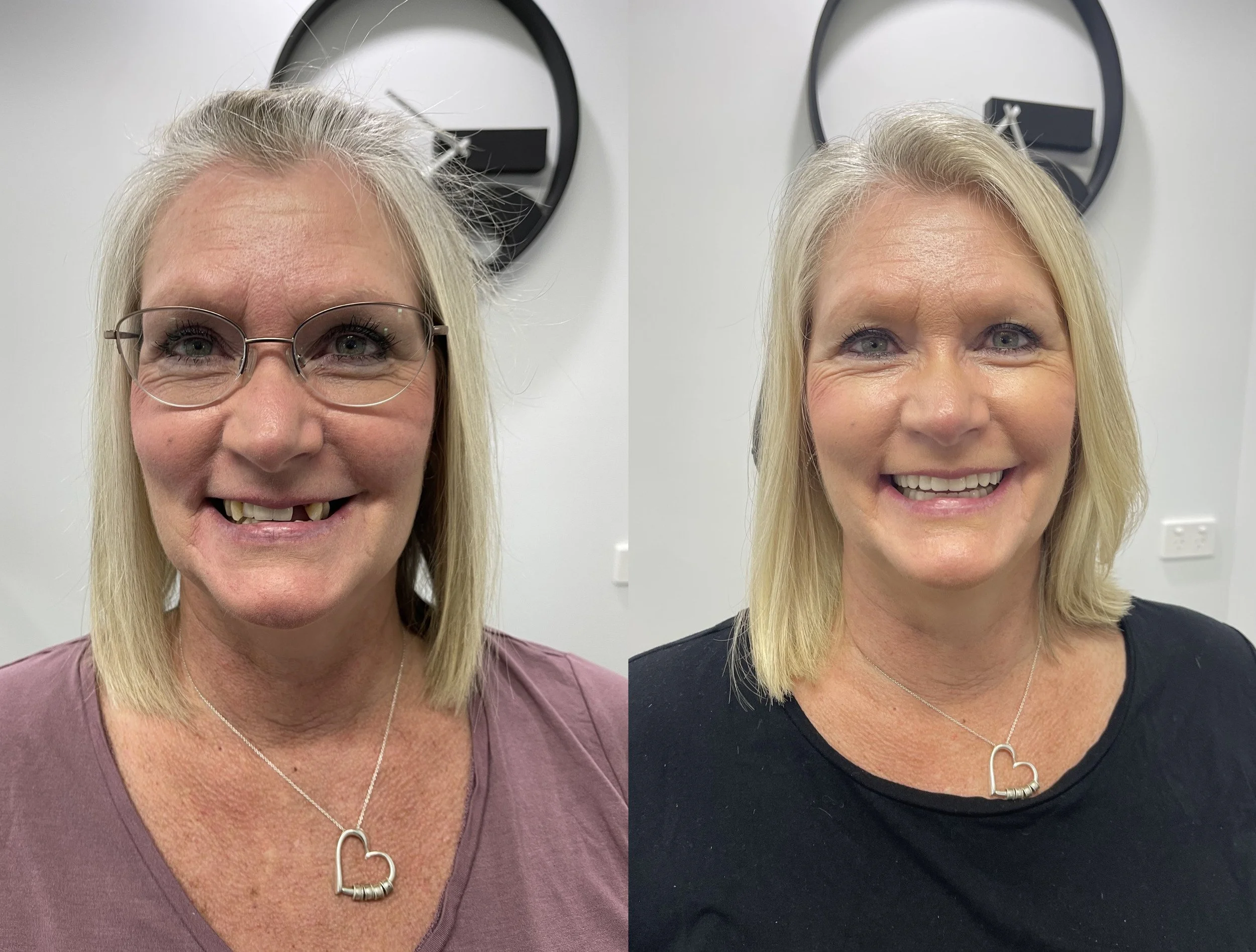 I’ve Broken My Dentures! What Should I Do? - Denture Haus