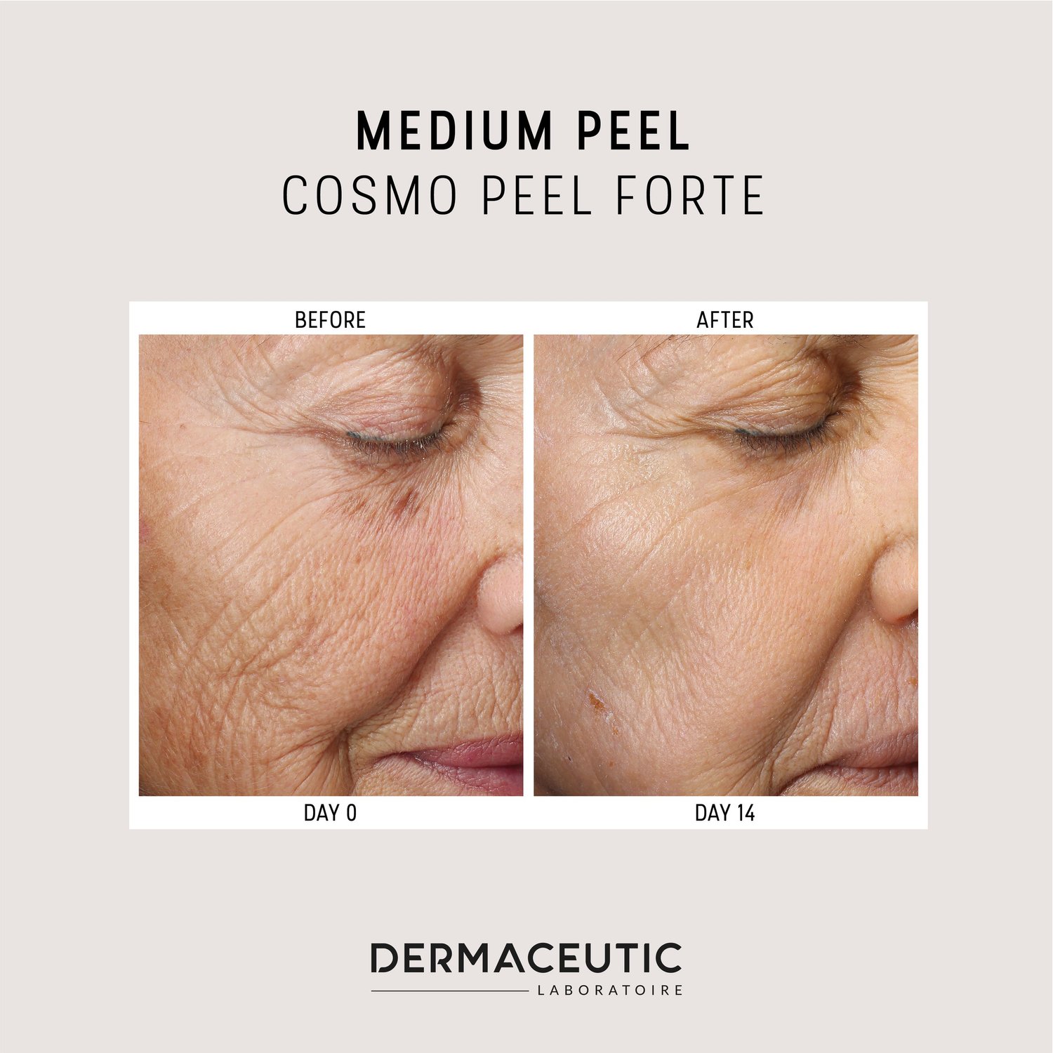 Resurfacing Medical Grade Peel — Medicura
