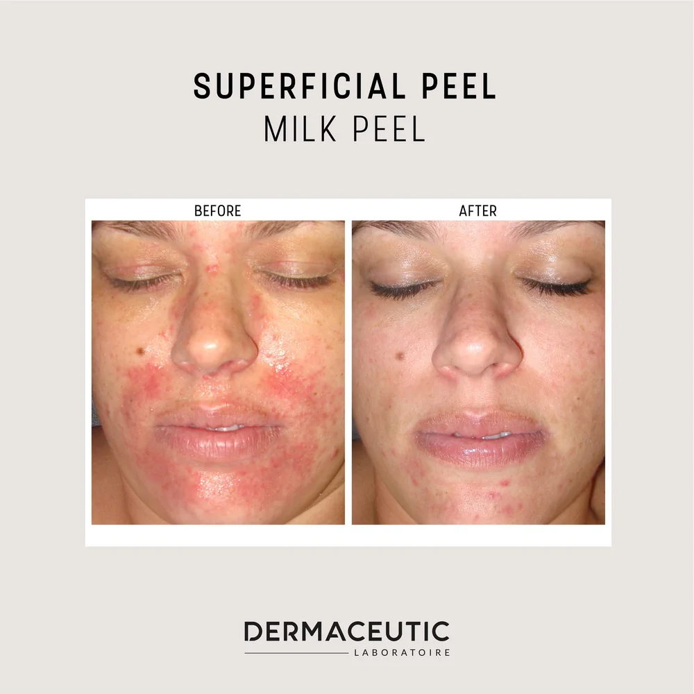 AHA & BHA Medical Grade Peel — Medicura