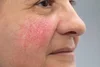 Thread Vein treatment Dublin — Edit Skin Clinic - Laser Tattoo Removal ...