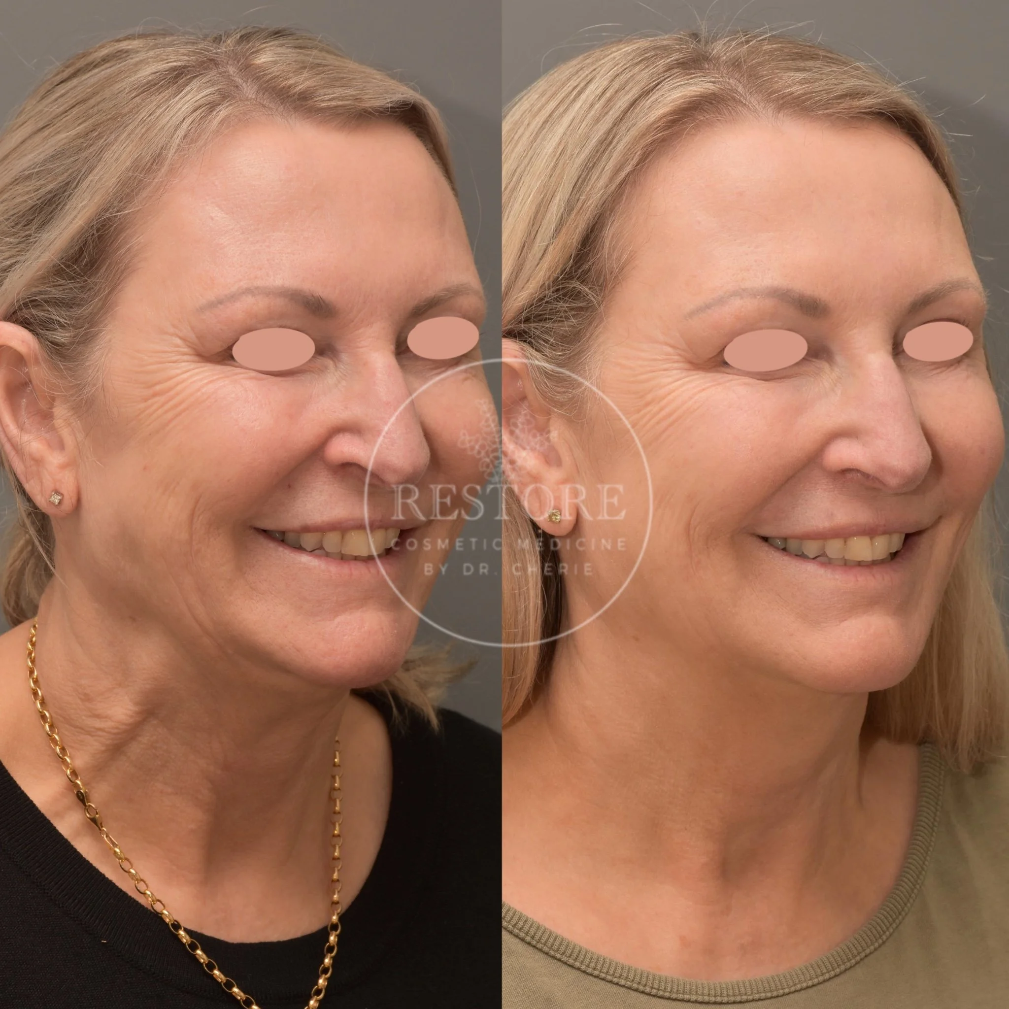 Profhilo — Restore Cosmetic Medicine by Dr. Cherie Wyatt-Hutana