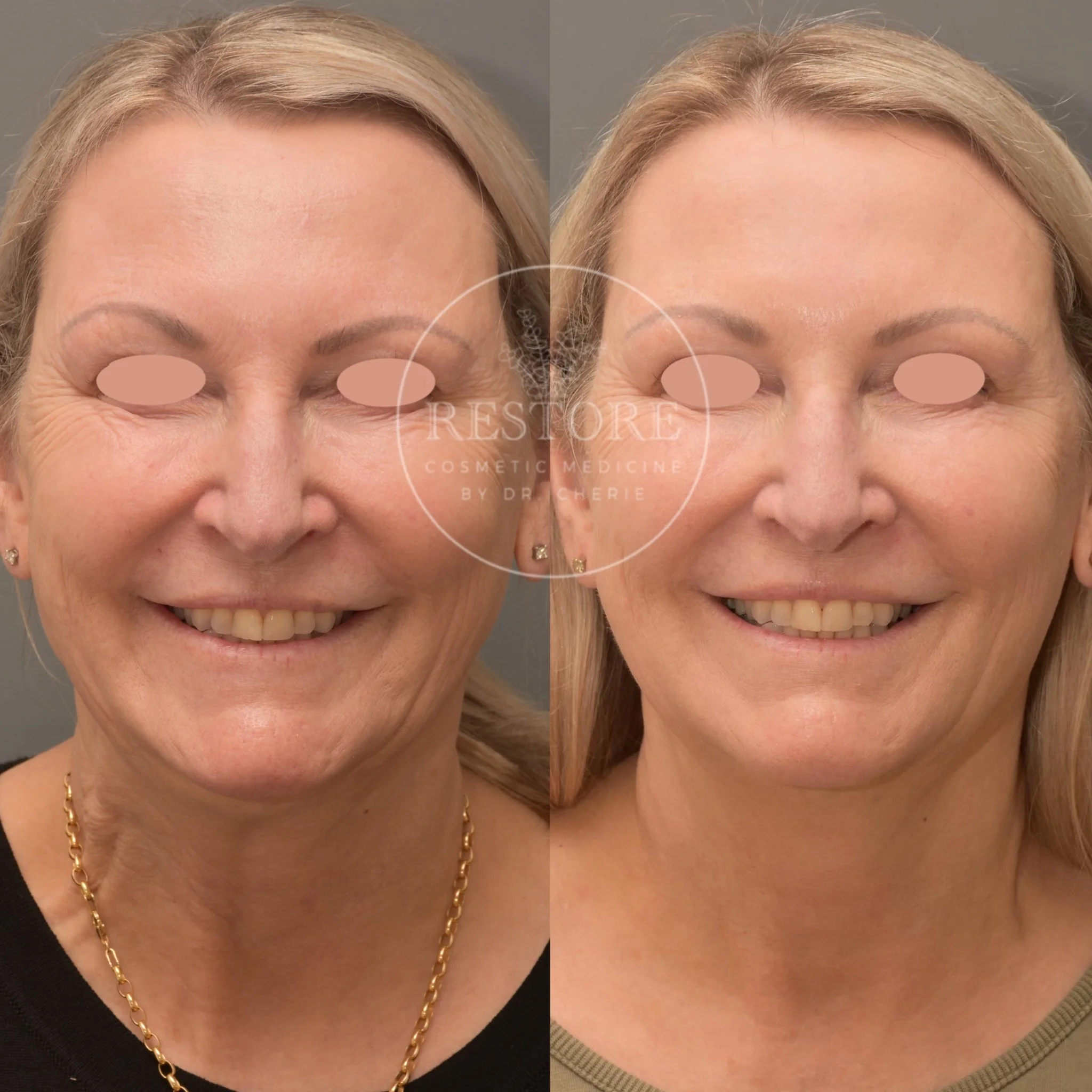 Profhilo — Restore Cosmetic Medicine by Dr. Cherie Wyatt-Hutana