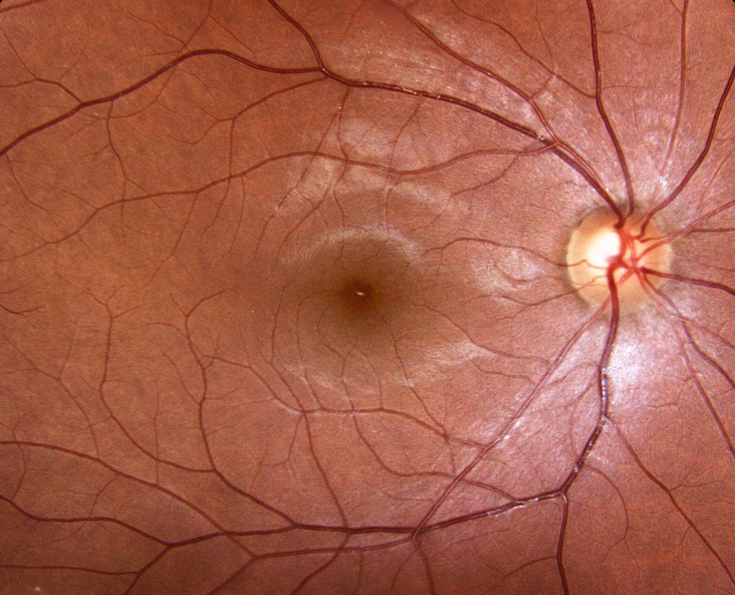 Retina — Premium Cataract Surgery and Advanced Dry Eye Treatment