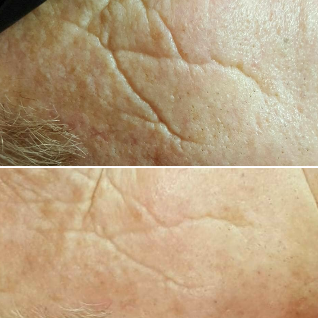 Laser Skin Rejuvenation Specialists in Bexhill, East Sussex — i-LASER