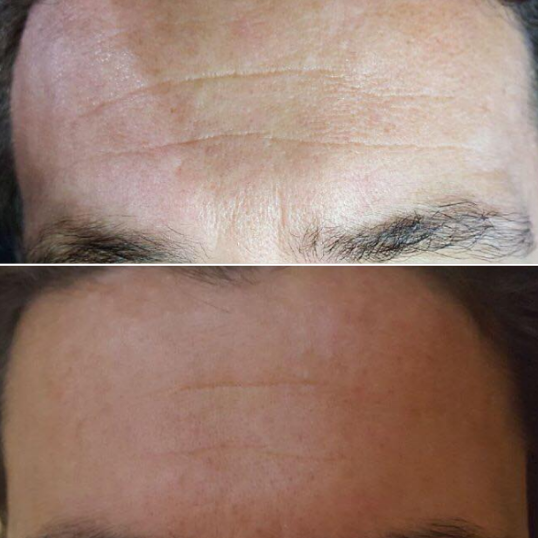 Laser Skin Rejuvenation Specialists in Bexhill, East Sussex — i-LASER