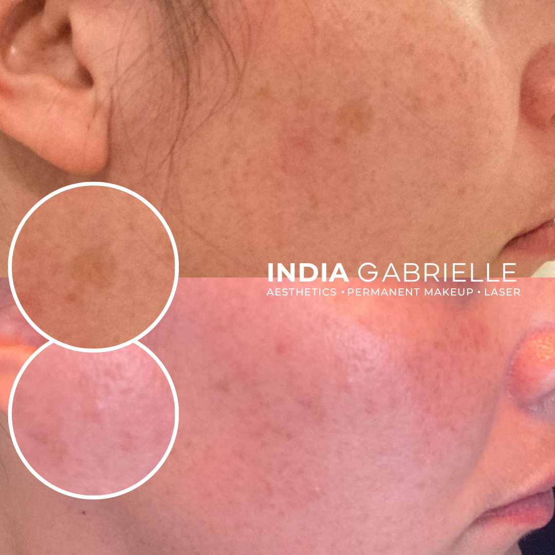 Best Pigmentation / Age Spot / Sun Spot / Hyperpigmentation Removal in ...