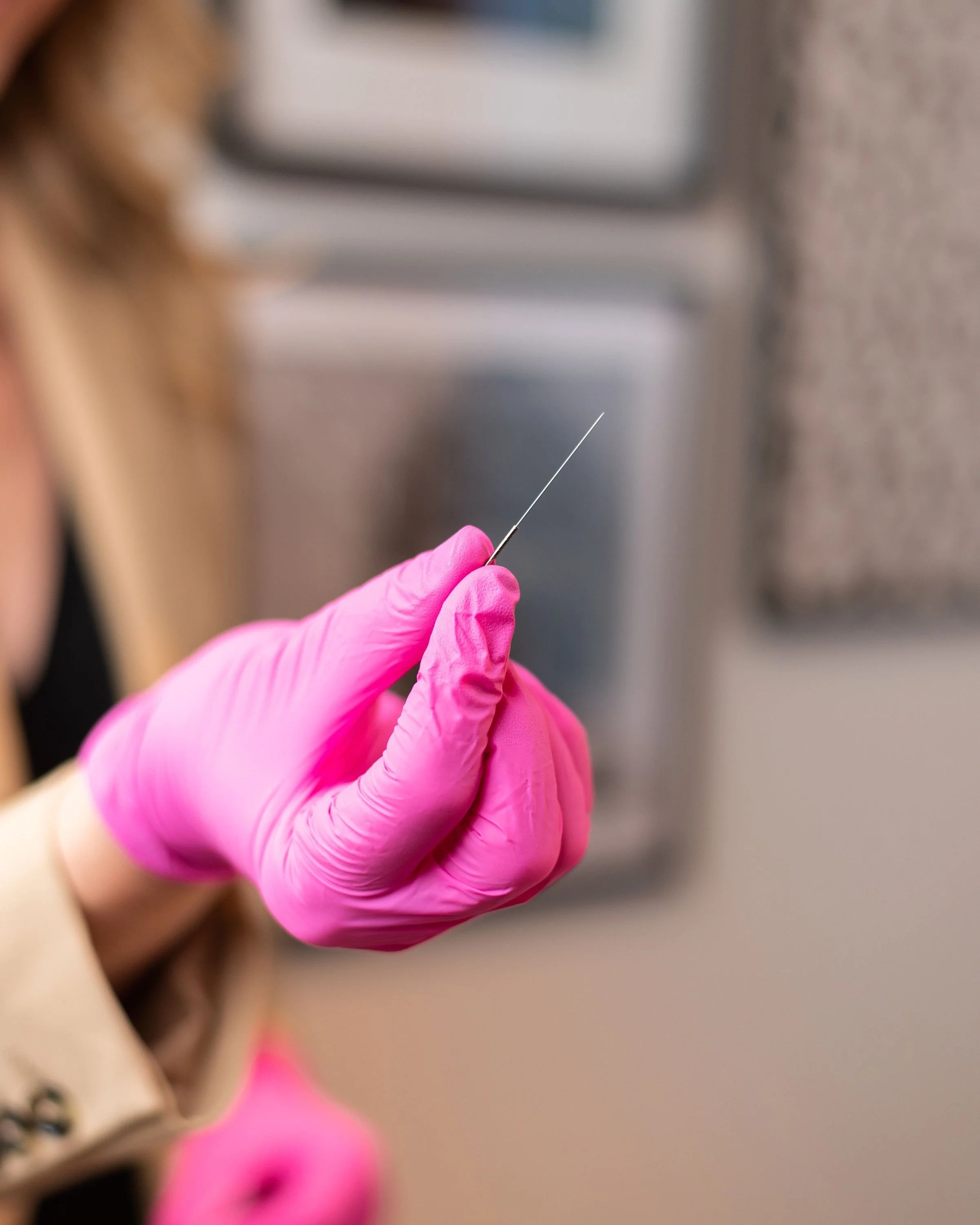 Acupuncture — Resilience Physiotherapy — Toronto, ON