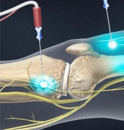 Radiofrequency Nerve Ablation(RFA) — SARC