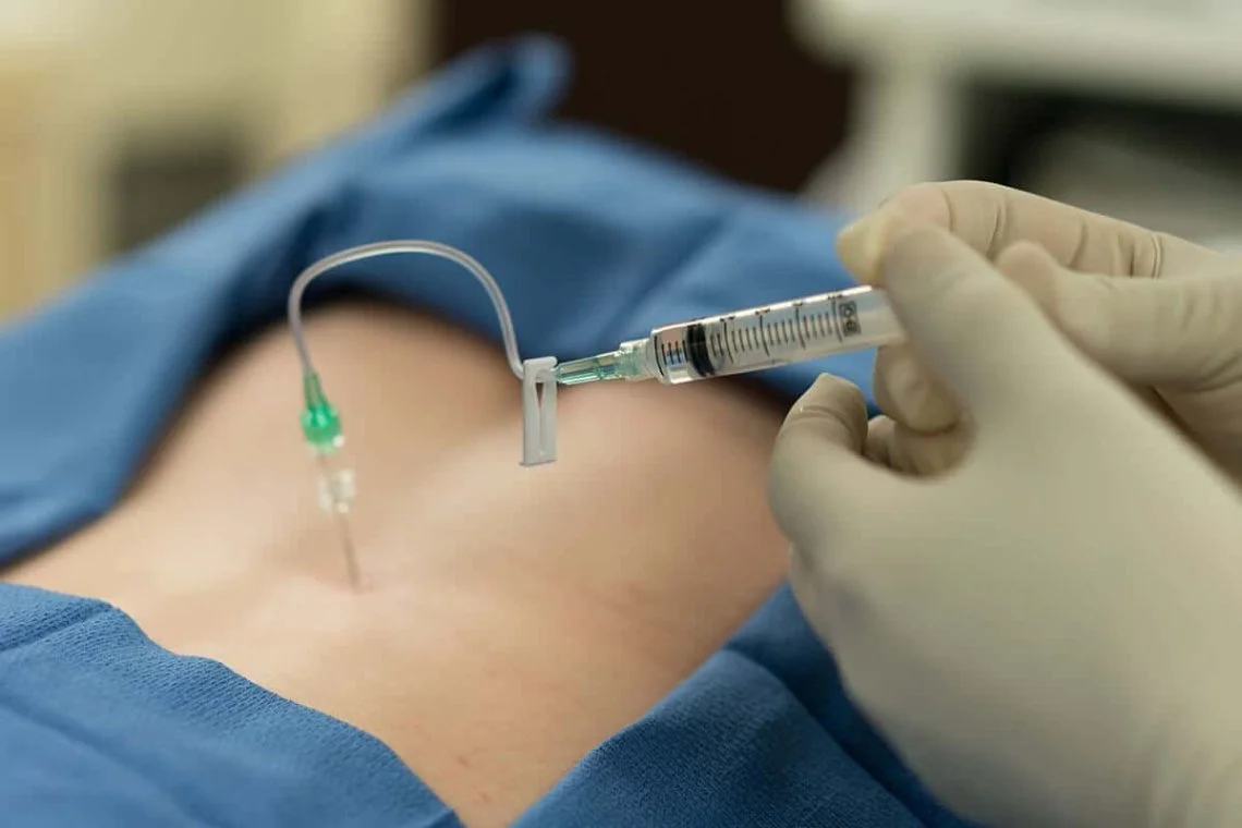 Lumbar Epidural Steroid Injections — SARC