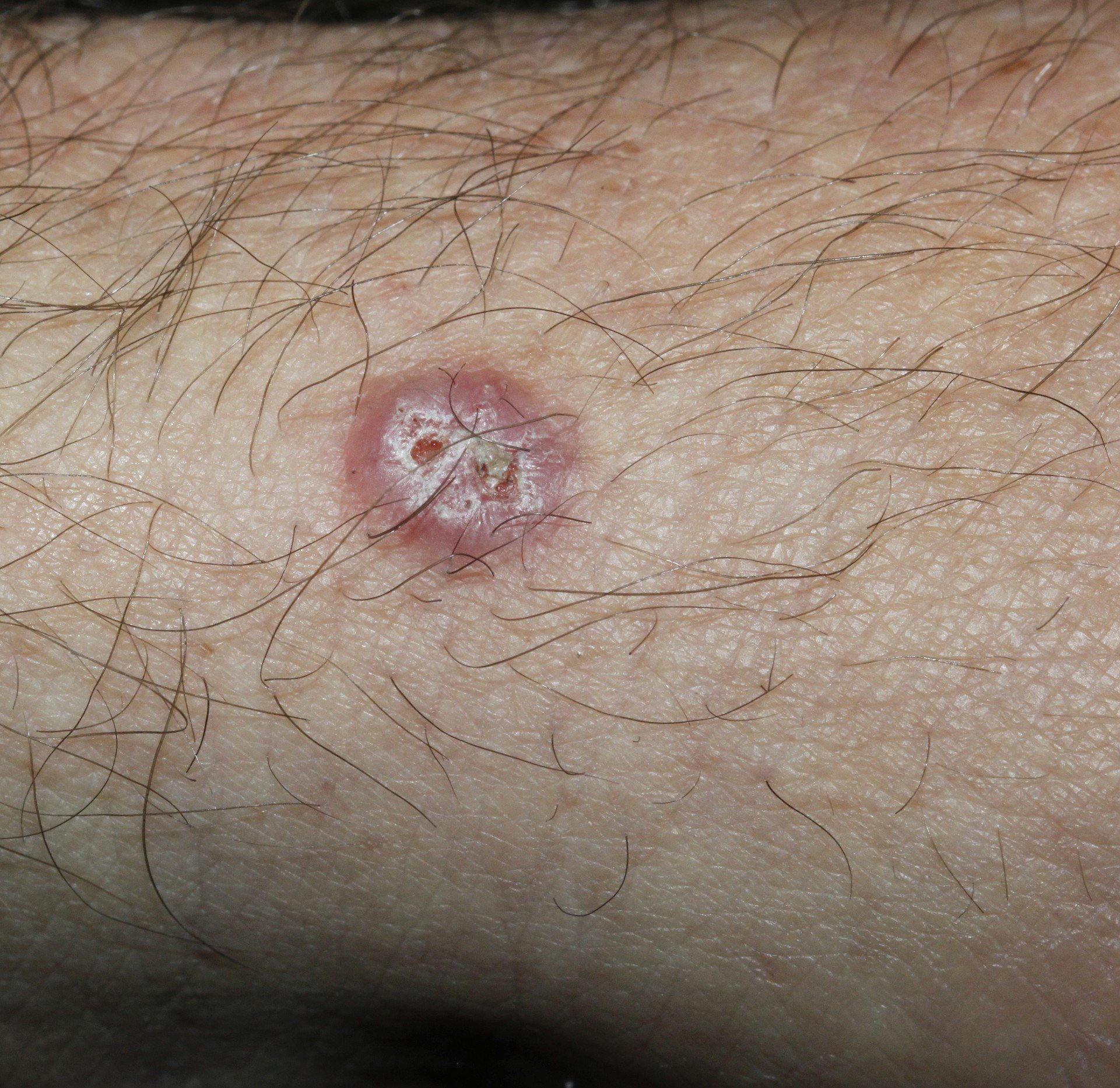 Basal Cell Carcinoma The Definitive Guide Skintel