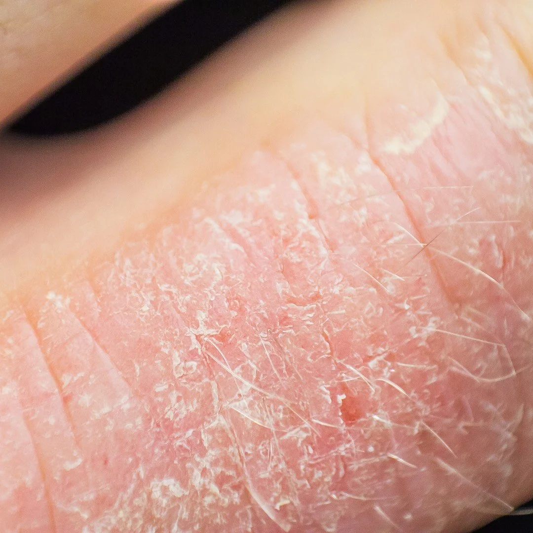 Eczema Facial Treatment | Facial Telford — Saintly Skincare