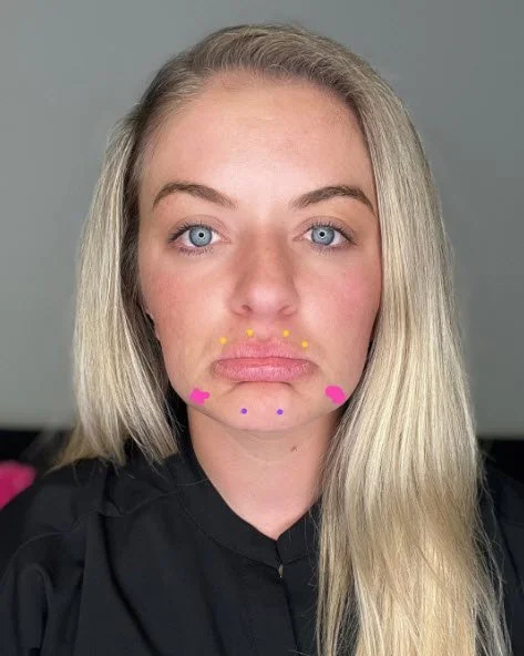 Exploring The Cost Of Botox & Treatment Options — Dr. Charlie Seltzer