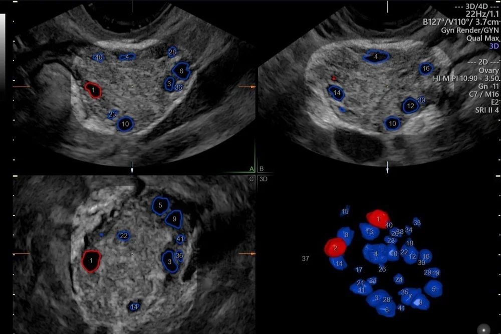 Follicle Tracking Scans — Trinity Imaging