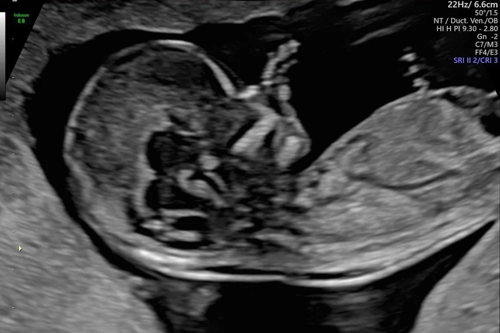 Nuchal Translucency Scans/ Early Anatomy Scans — Trinity Imaging