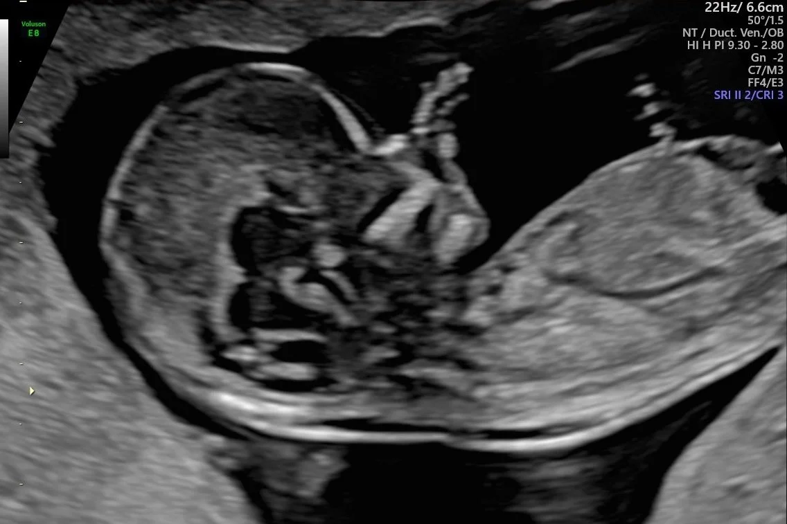 Nuchal Translucency Scans/ Early Anatomy Scans — Trinity Imaging