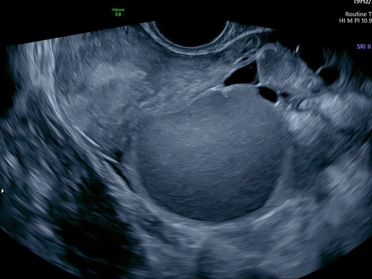 Deep Infiltrating Endometriosis Scans — Trinity Imaging