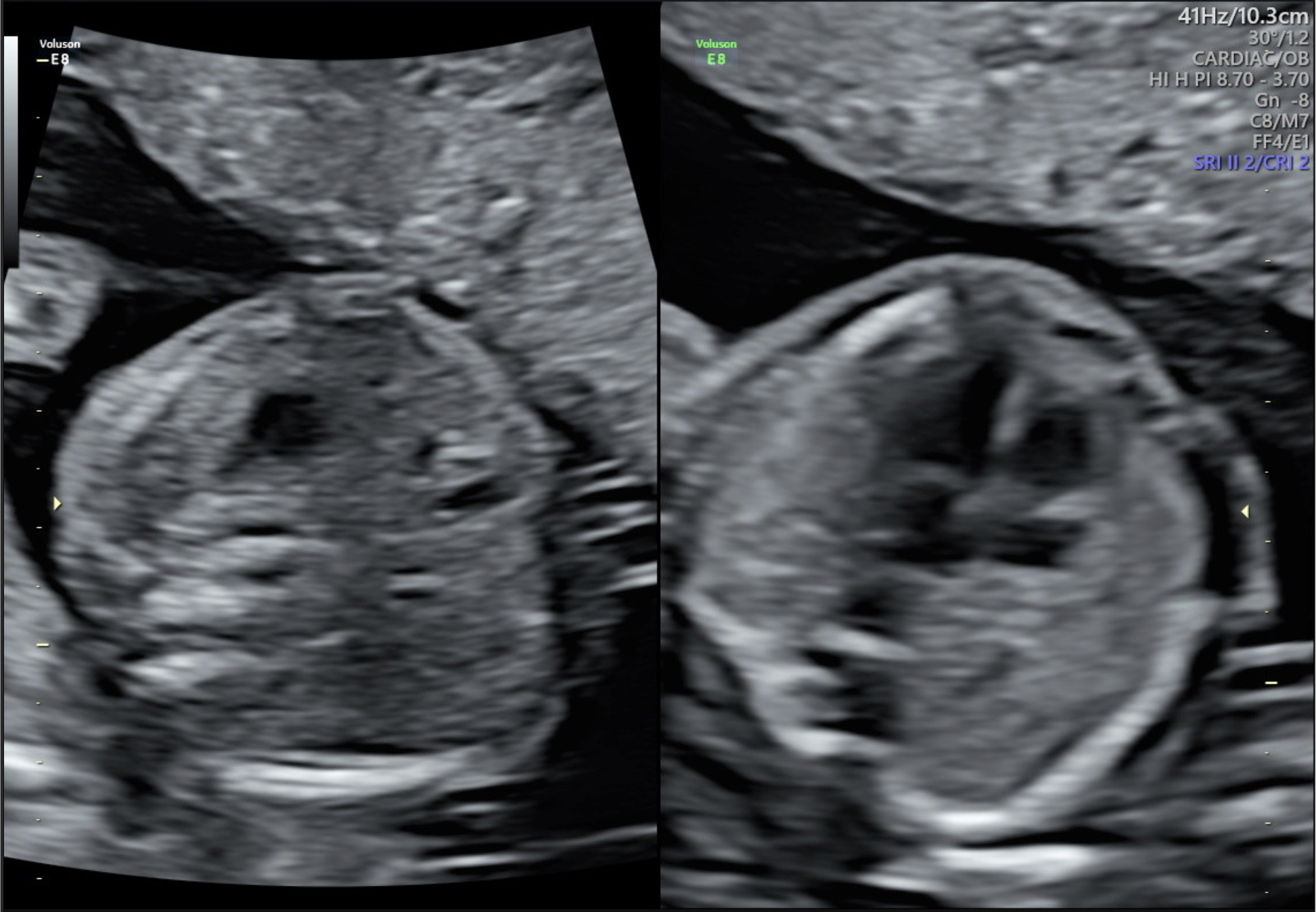 Early Anatomy Scans — Trinity Imaging