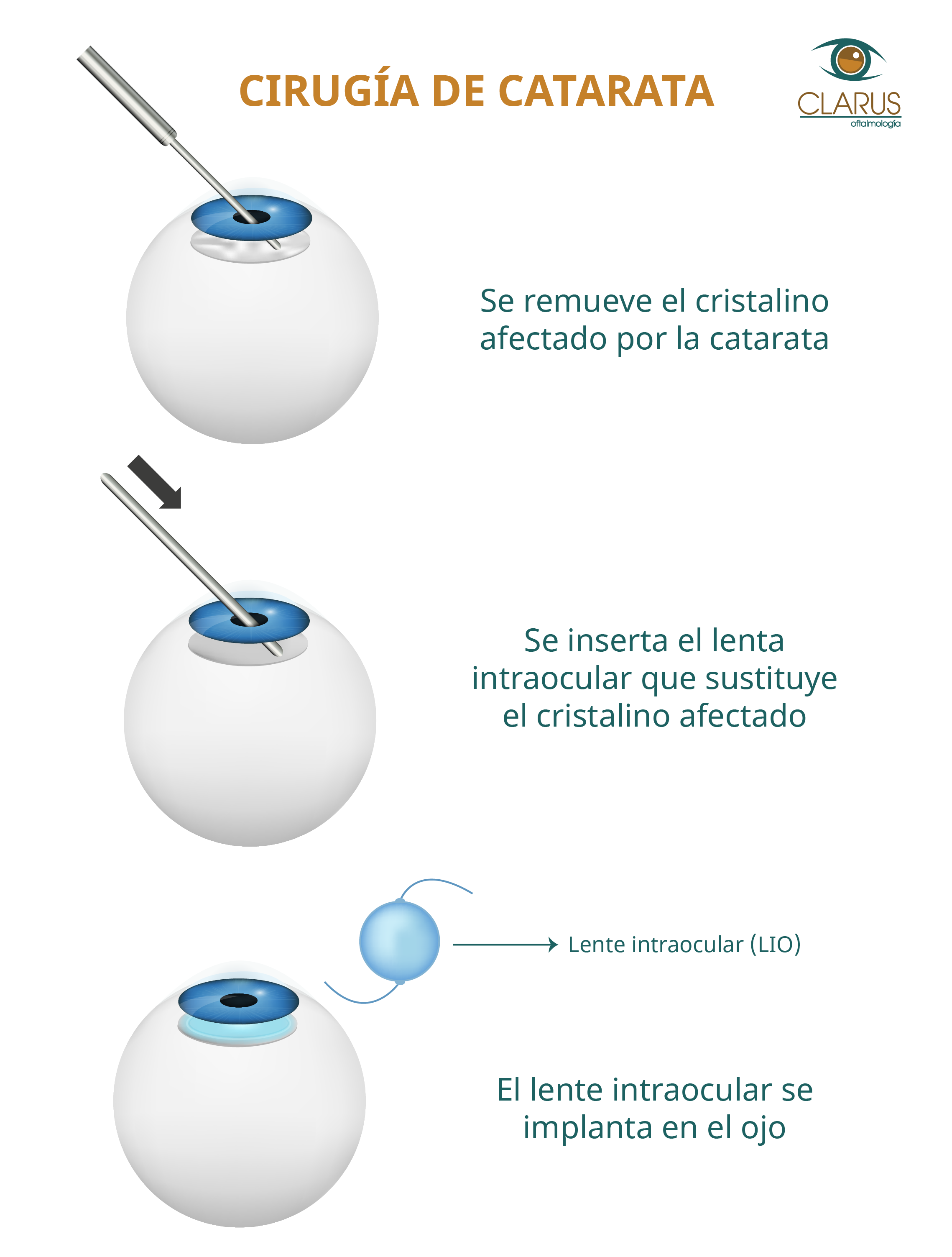 Cirugía de Catarata — Clarus Oftalmología