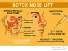 Botox Nose Lift: Tip Elevation Guide | MD Body & Med Spa — MD Body ...