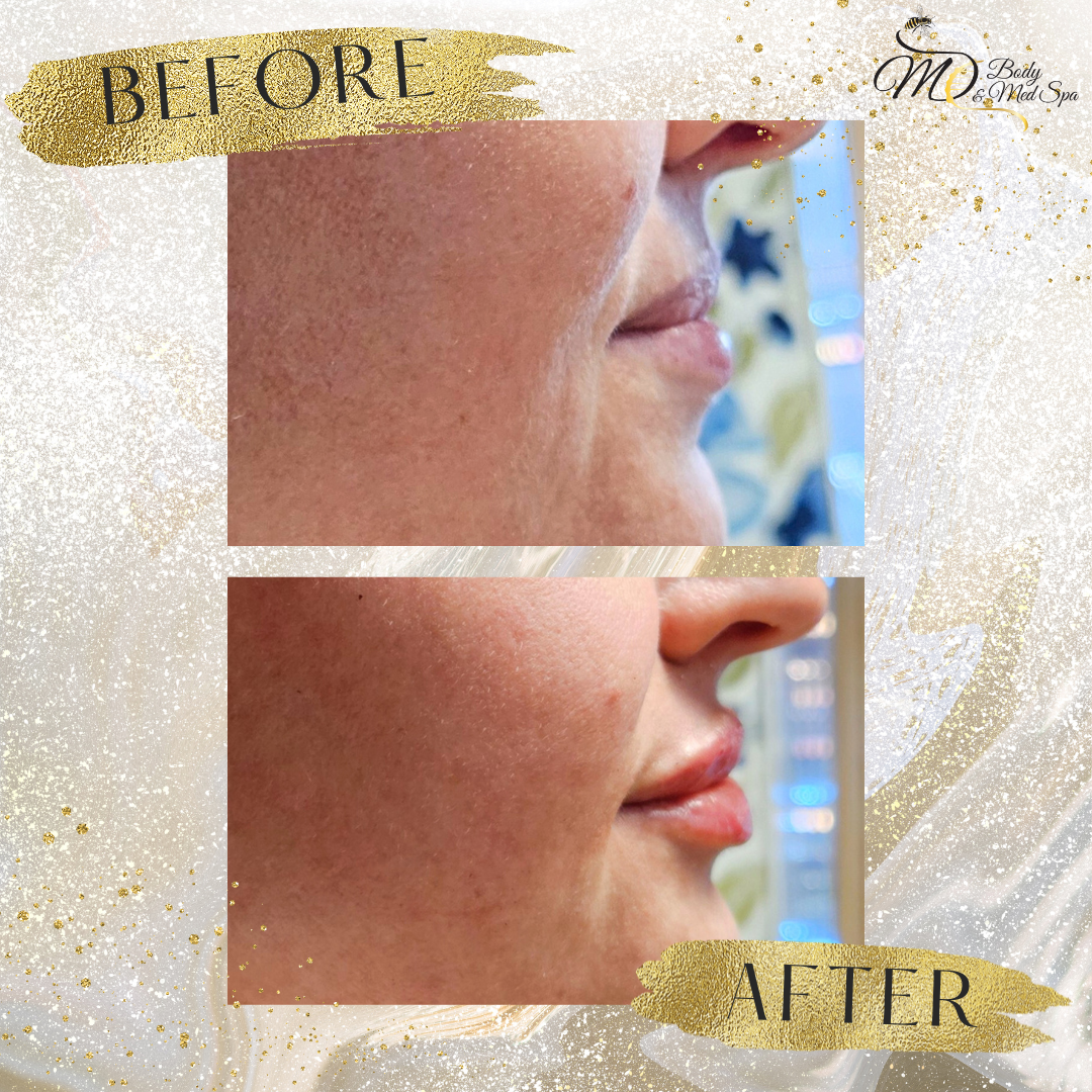 Neurotoxins 101: A Deep Dive into Their Role and Impact — MD Body & Med Spa