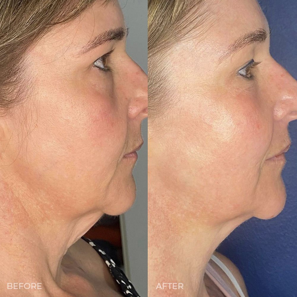 Jet Plasma Therapy — Relished Food Holistic Nutrition