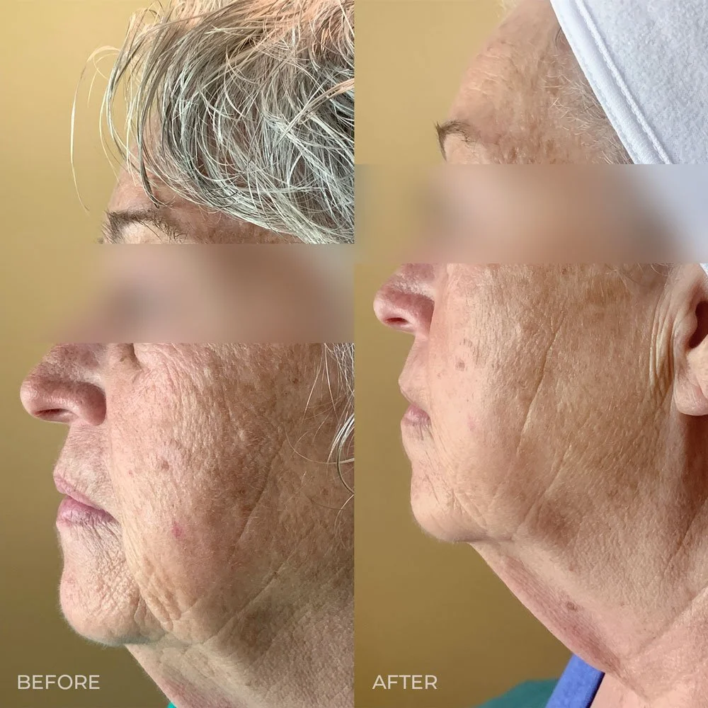 Jet Plasma Therapy — Relished Food Holistic Nutrition