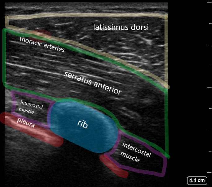 Blocks: Serratus Anterior — Ultra Sono