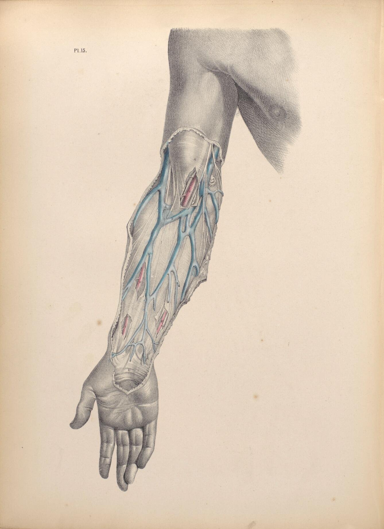 Procedures: Vascular Access — Ultra Sono