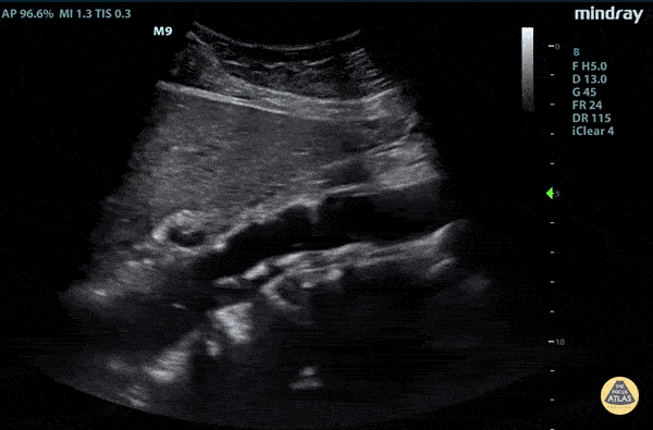 Aorta — Ultra Sono