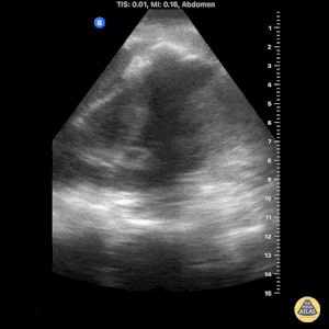 Renal — Ultra Sono