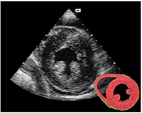 Heart: Basics — Ultra Sono