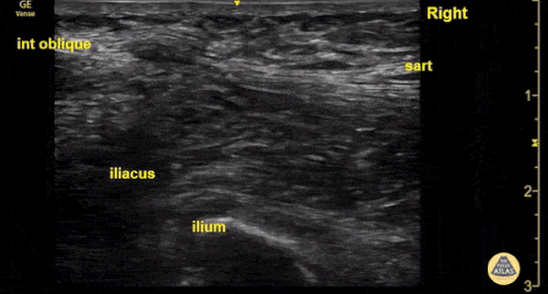 Blocks: Fascia Iliaca — Ultra Sono