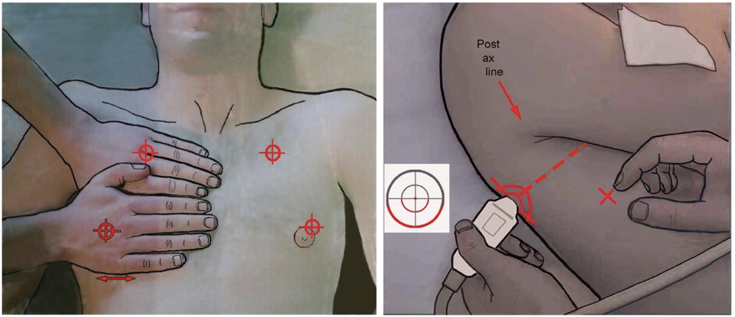 Lung — Ultra Sono
