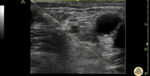 Blocks: Fascia Iliaca — Ultra Sono