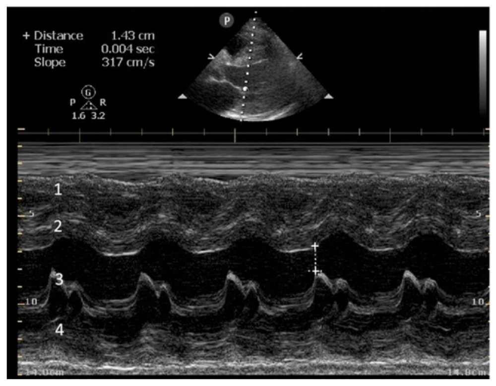 Heart: Interpretation — Ultra Sono