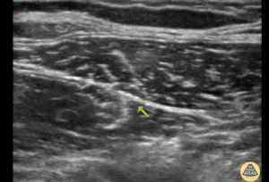 Blocks: Fascia Iliaca — Ultra Sono