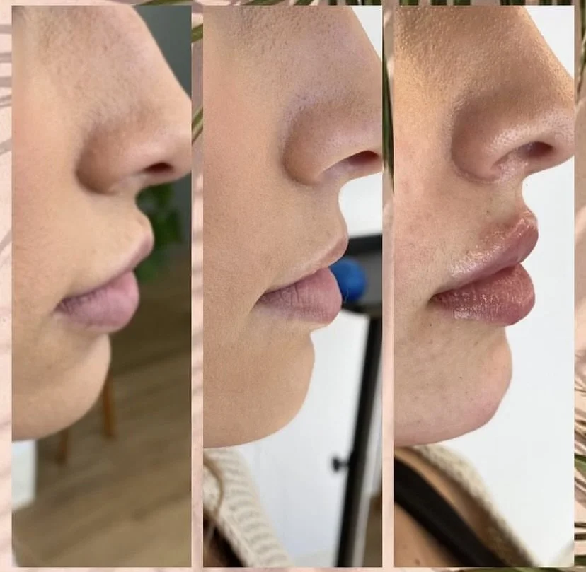 Lip Filler Migration | Hebe Beauty Bar Red Deer
