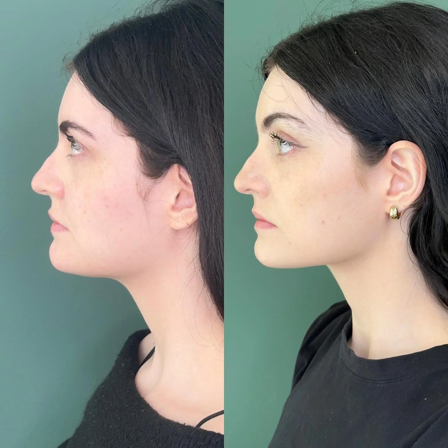Medical Aesthetics & Skin Treatments Red Deer, AB | Hebe Beauty Bar