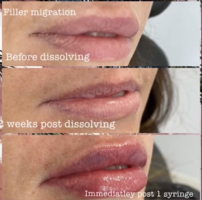 Lip Filler Migration | Hebe Beauty Bar Red Deer