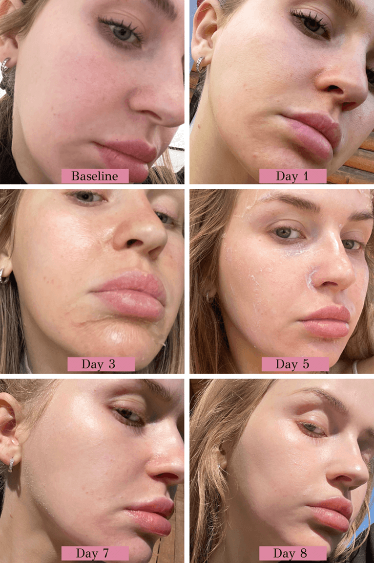 The Perfect Peel | Perfect Peel Before and After Red Deer, AB | Hebe ...