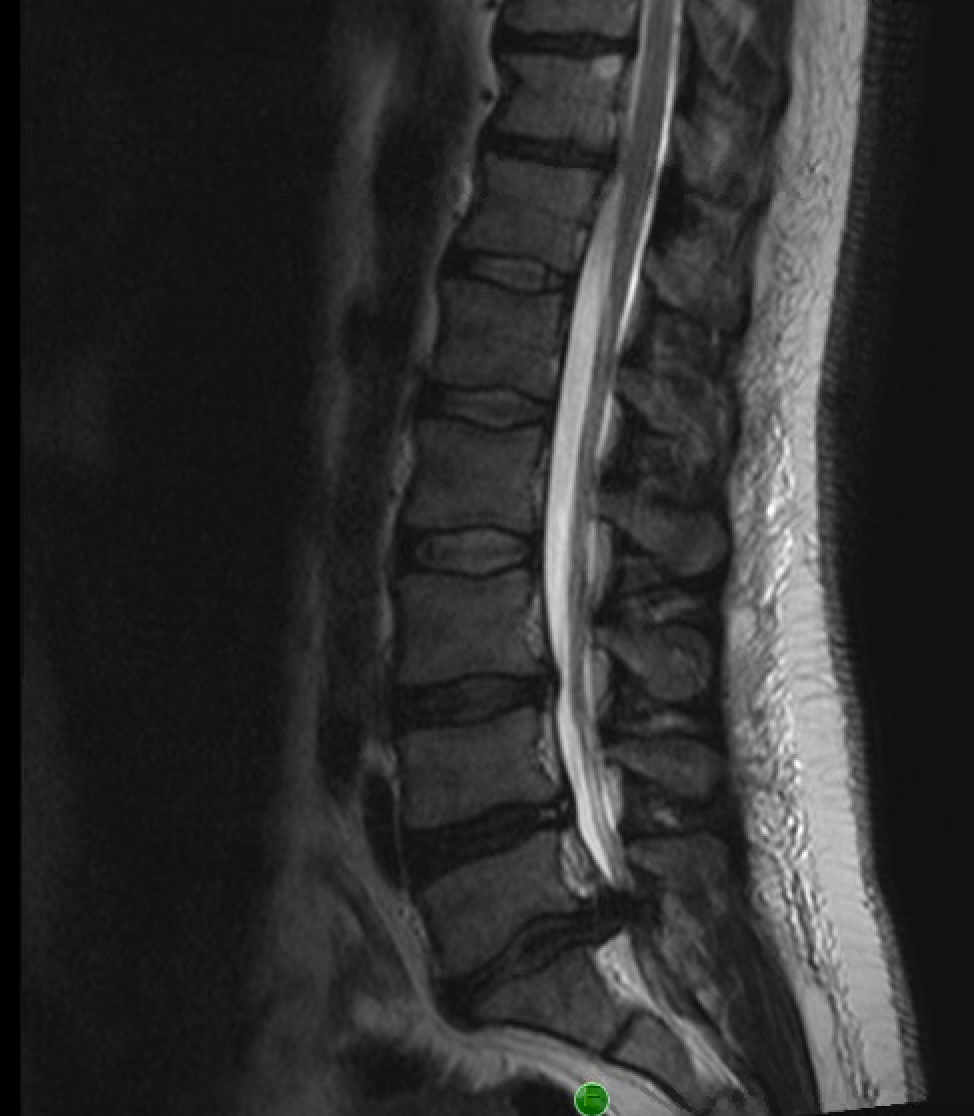 Spine — Jeffrey Hatef, M.D. - Columbus Neurosurgeon