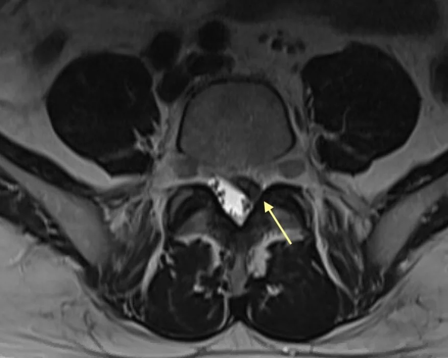 Radiculopathy And Sciatica Jeffrey Hatef M D Columbus Neurosurgeon