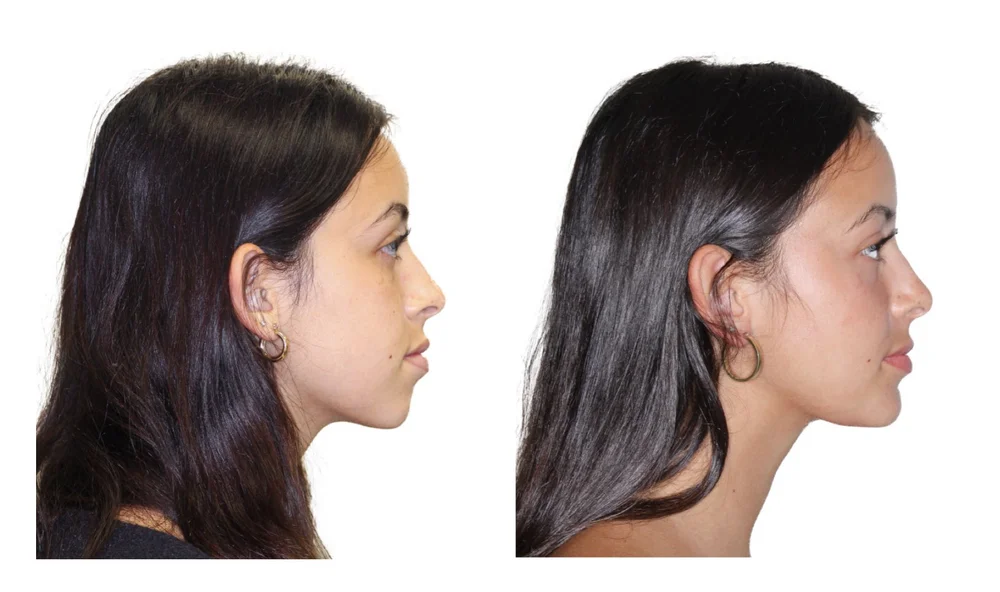 Before & After — Elite Oral and Facial Surgery- Long Island Oral and ...