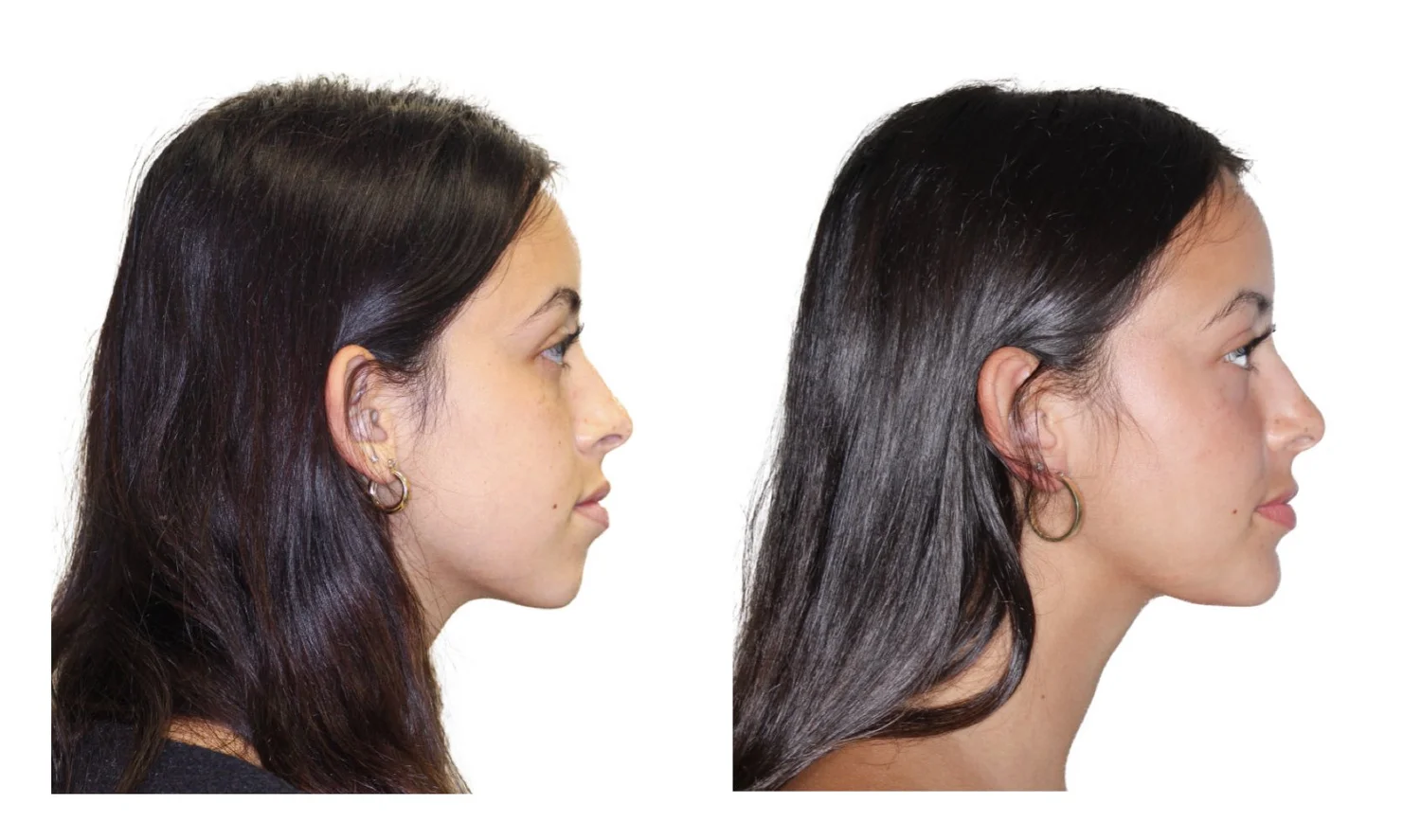 Before & After — Elite Oral and Facial Surgery- Long Island Oral and ...