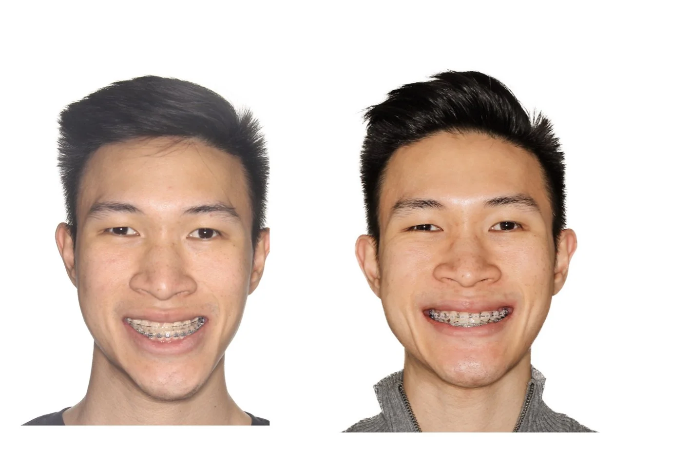 Class III/asymmetry — Elite Oral and Facial Surgery- Long Island Oral ...