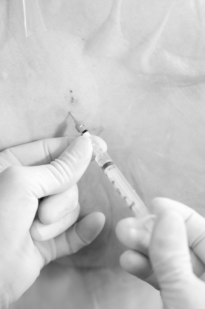 Epidural Injections | Relieve Pain Today — Dr. Dan Bates