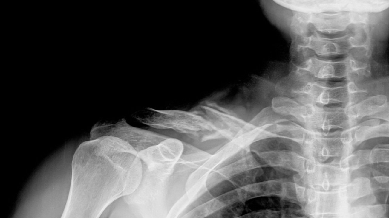 Sacroiliac Joint Block | Learn More Today — Dr. Dan Bates