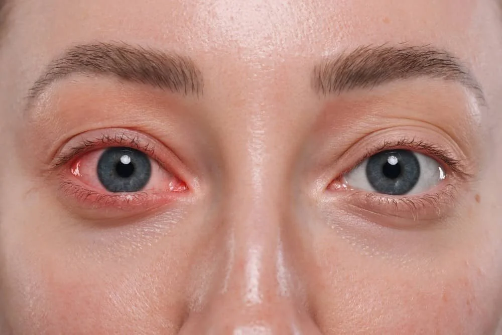 Red Eye: Bloodshot Eye Causes, Treatment - Should I Be Worried?