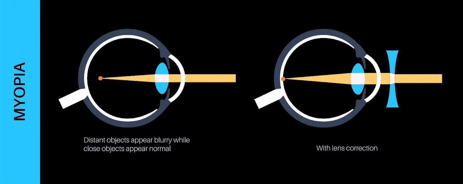 Myopia Lenses: Our Complete Guide for Myopia Spectacle Lenses