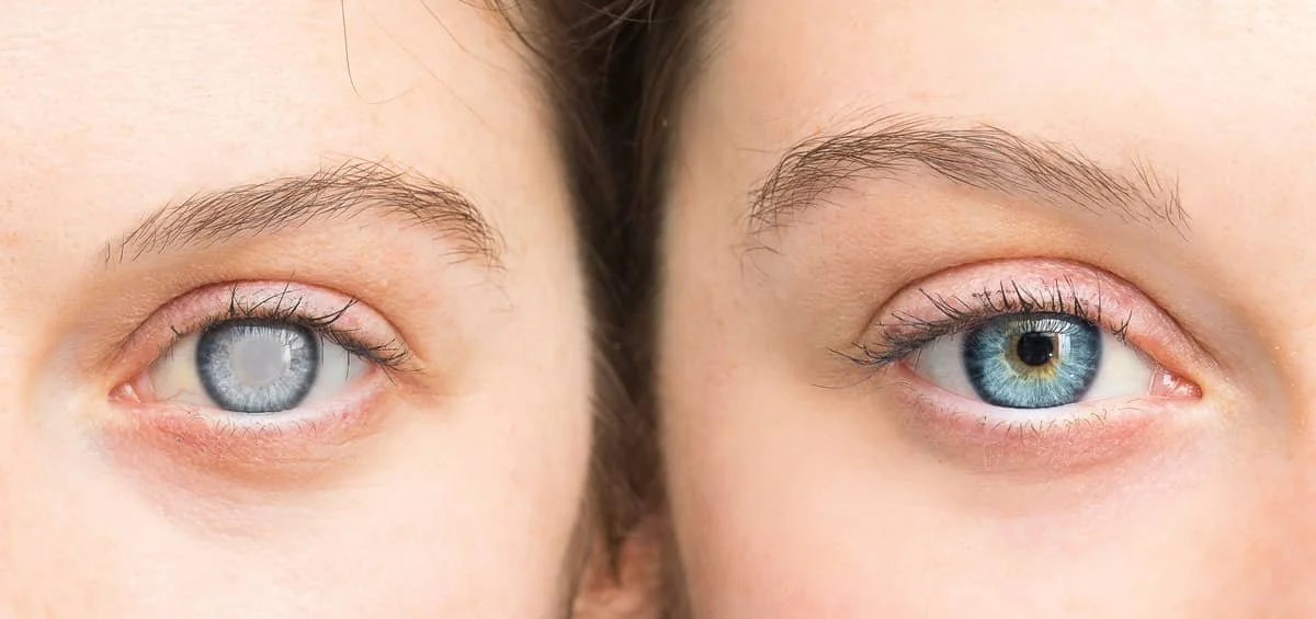 How Optometrists Support Visual Rehabilitation After Pediatric Cataract ...